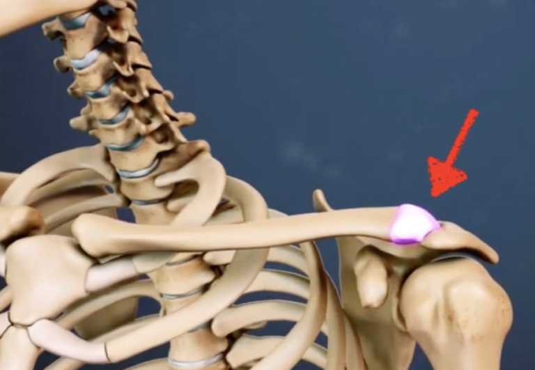 Artrose Acromioclavicular: O Que é, Causas, Sintomas e Tratamentos para ...